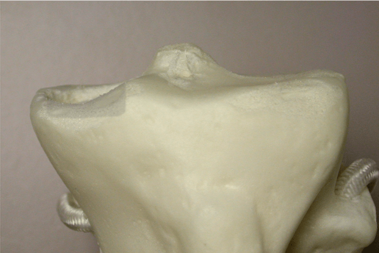 Different kinds of partial knee – Dr. Martin Redish