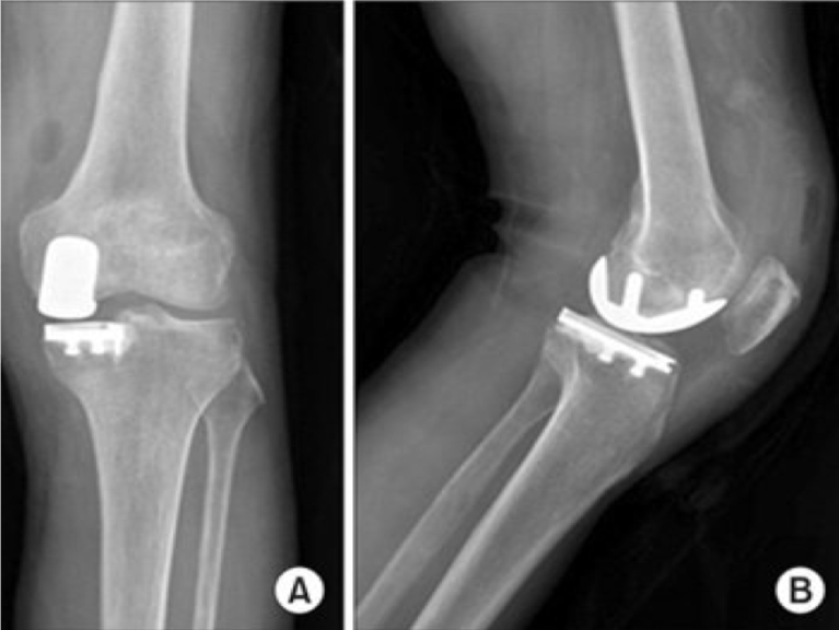 Different kinds of partial knee – Dr. Martin Redish